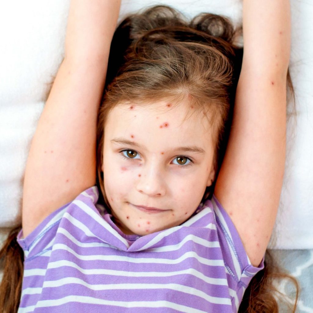 Varicelle : vaccination, évolution et traitement - Helsana